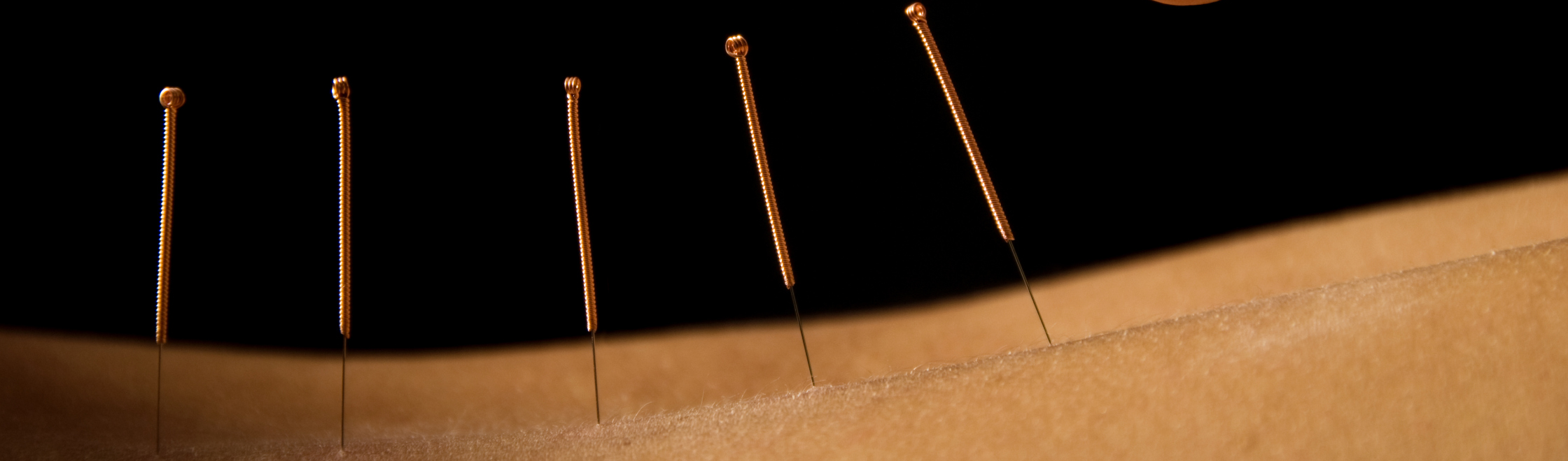 Acupuncture – Aimée's Acupuncture Clinic
